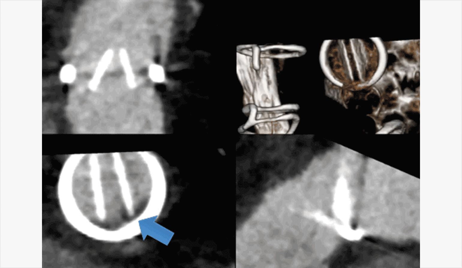 Cardiac CT Mechanical Valve Prosthesis Dysfunction Diagnosis - Mass ...
