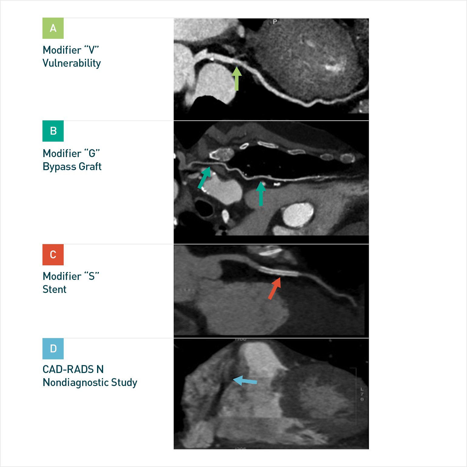 Coronary Artery Disease - Reporting & Data System (CAD-RADS) - Mass ...