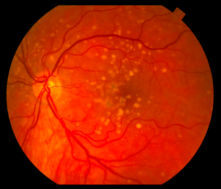 Telemedicine for Diagnosis and Management of AMD - Mass General ...