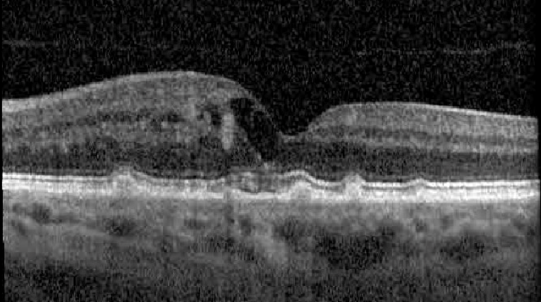 Telemedicine for Diagnosis and Management of AMD - Mass General ...