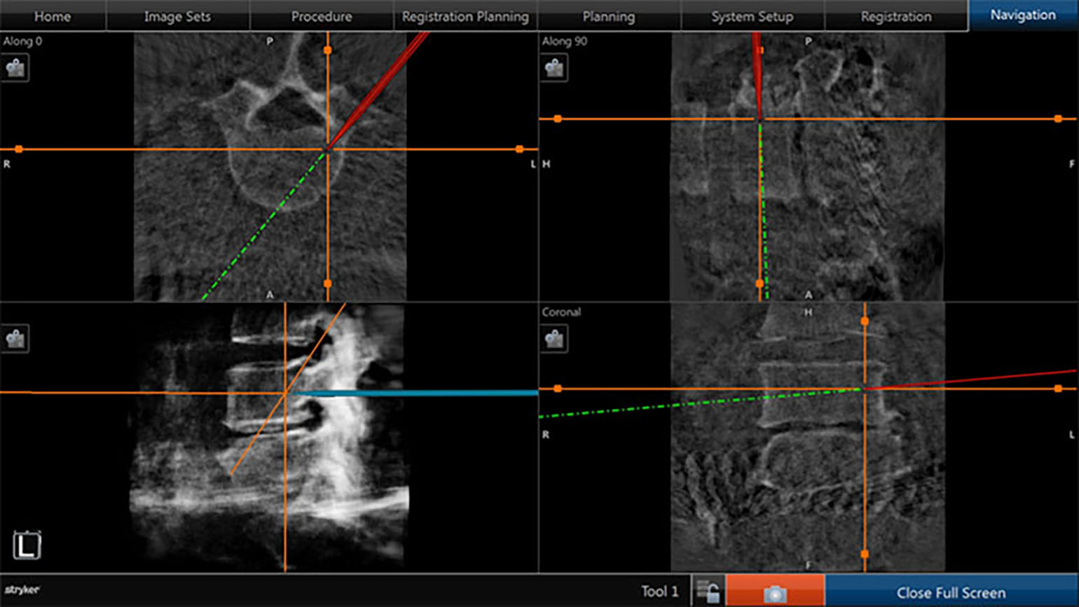 Minimally Invasive Spine Surgery: Enhancing Clinical Outcomes - Mass ...