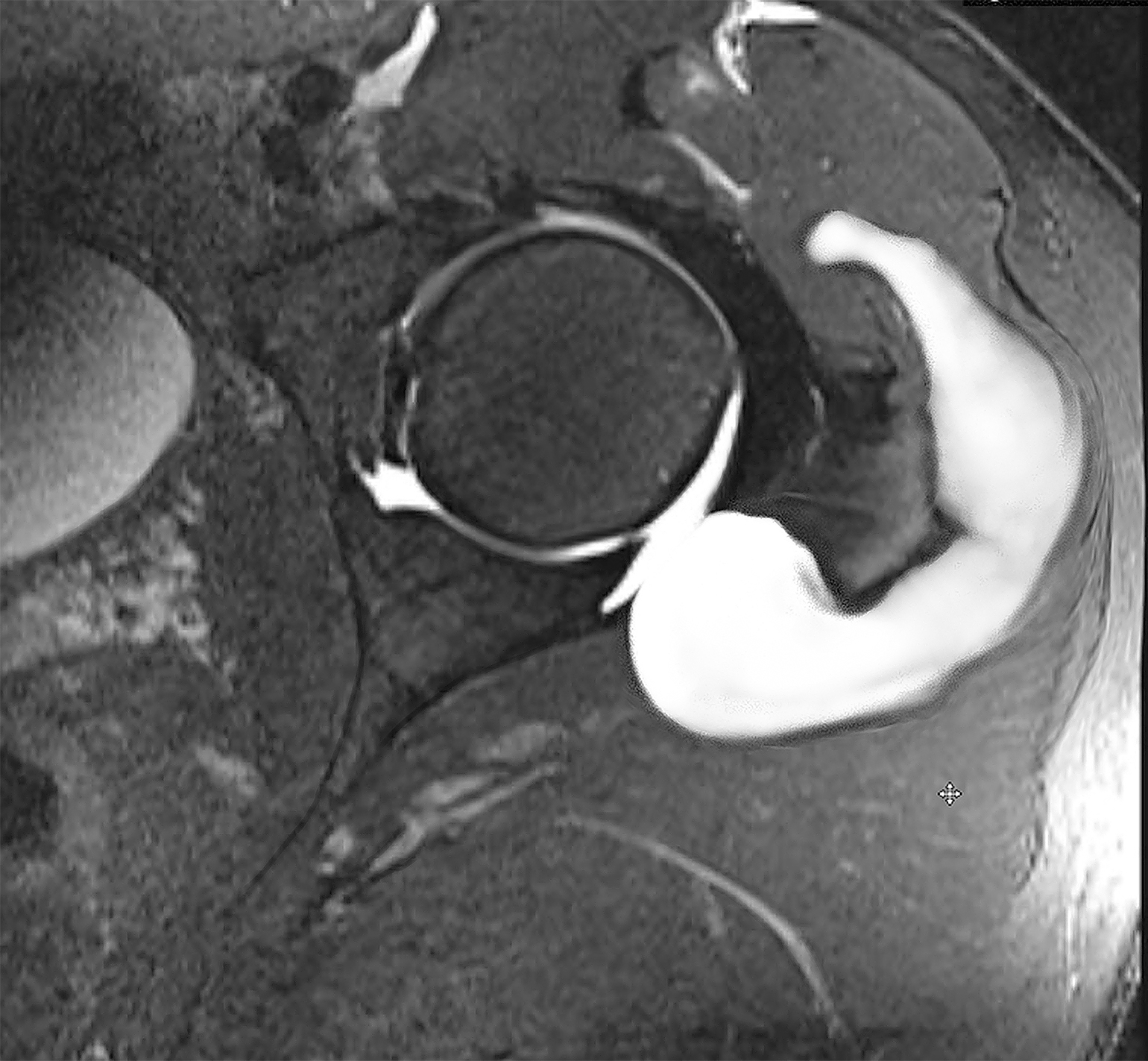Use of Puncture Capsulotomy During Hip Arthroscopy - Mass General ...