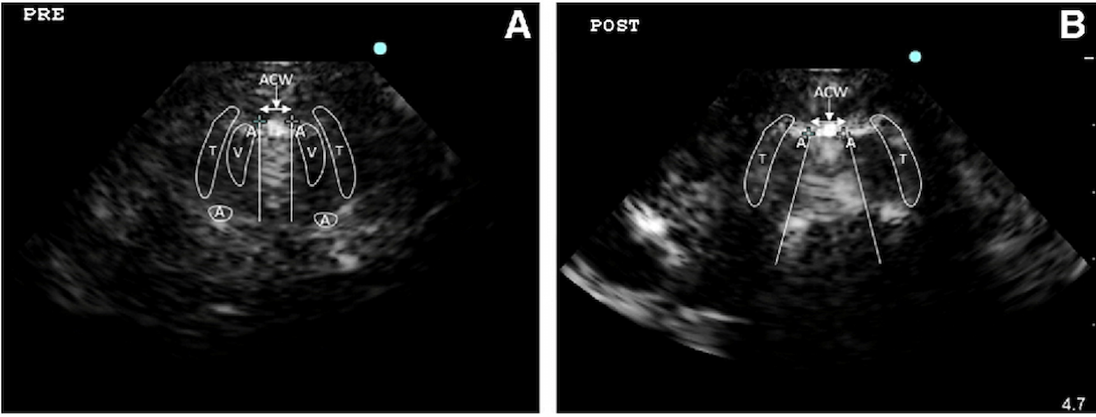 Post-extubation Stridor in COVID-19 - Mass General Advances in Motion