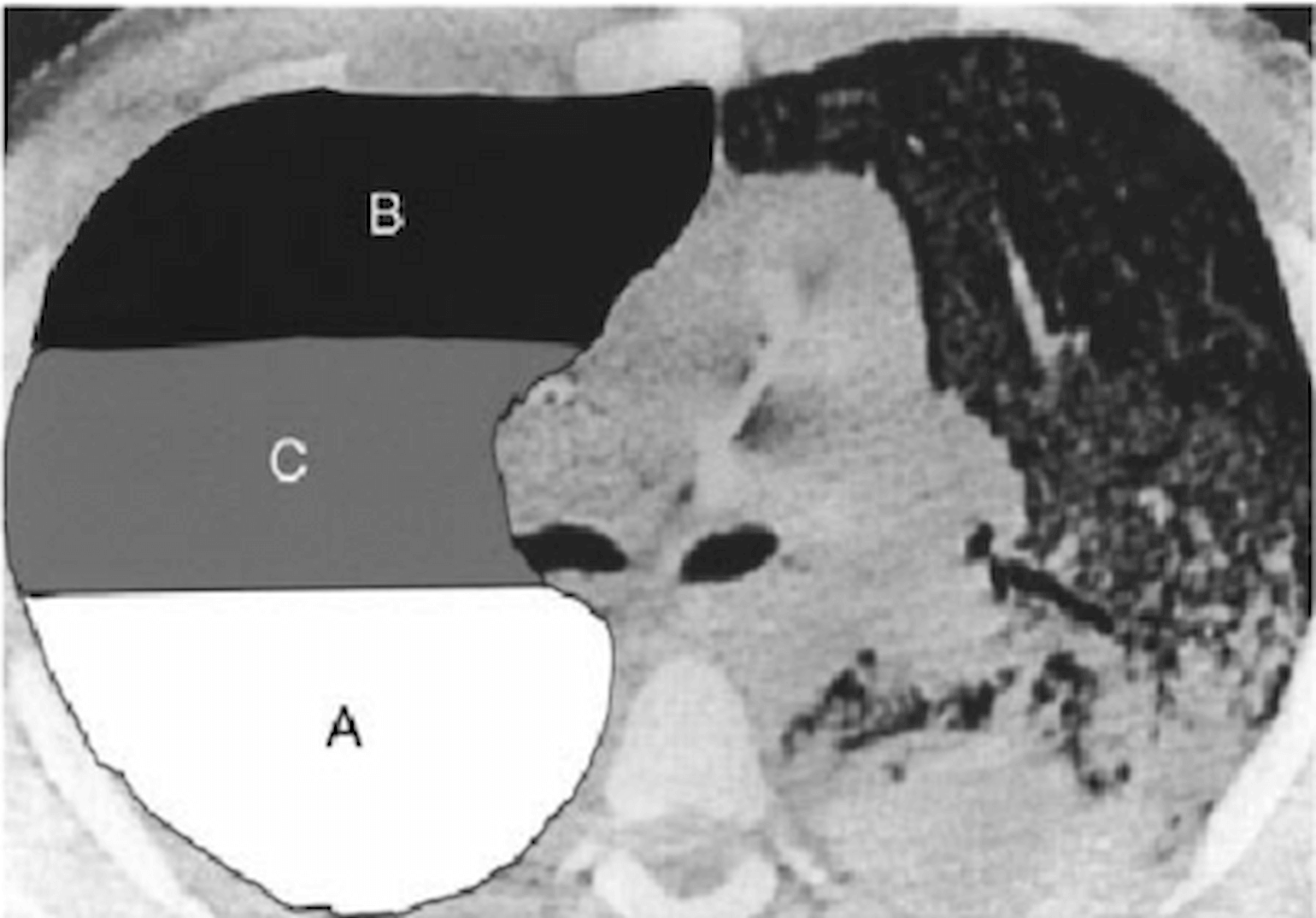 Managing PEEP and Recruitment - Mass General Advances in Motion
