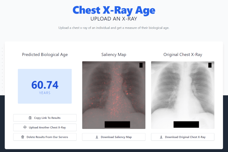 AI Estimates Biological Age, Predicts Mortality from a Chest X-ray ...