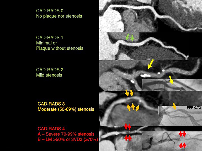 Screening Patients with Chest Pain Symptoms Using Coronary CT ...