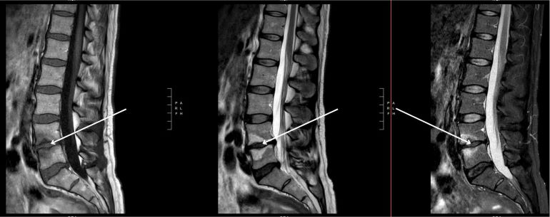 Innovative Therapy for Low Back Pain Takes the Fight to the Source ...