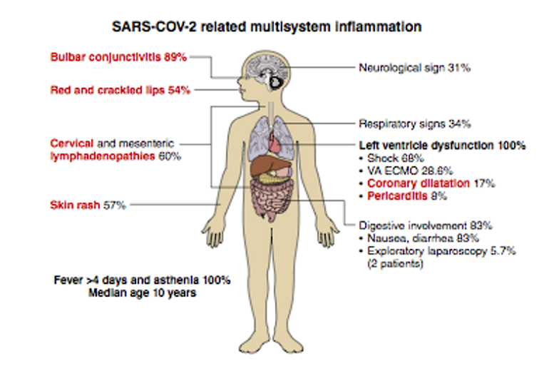 Pediatric Multisystem Inflammatory Syndrome and COVID-19 - Mass General ...
