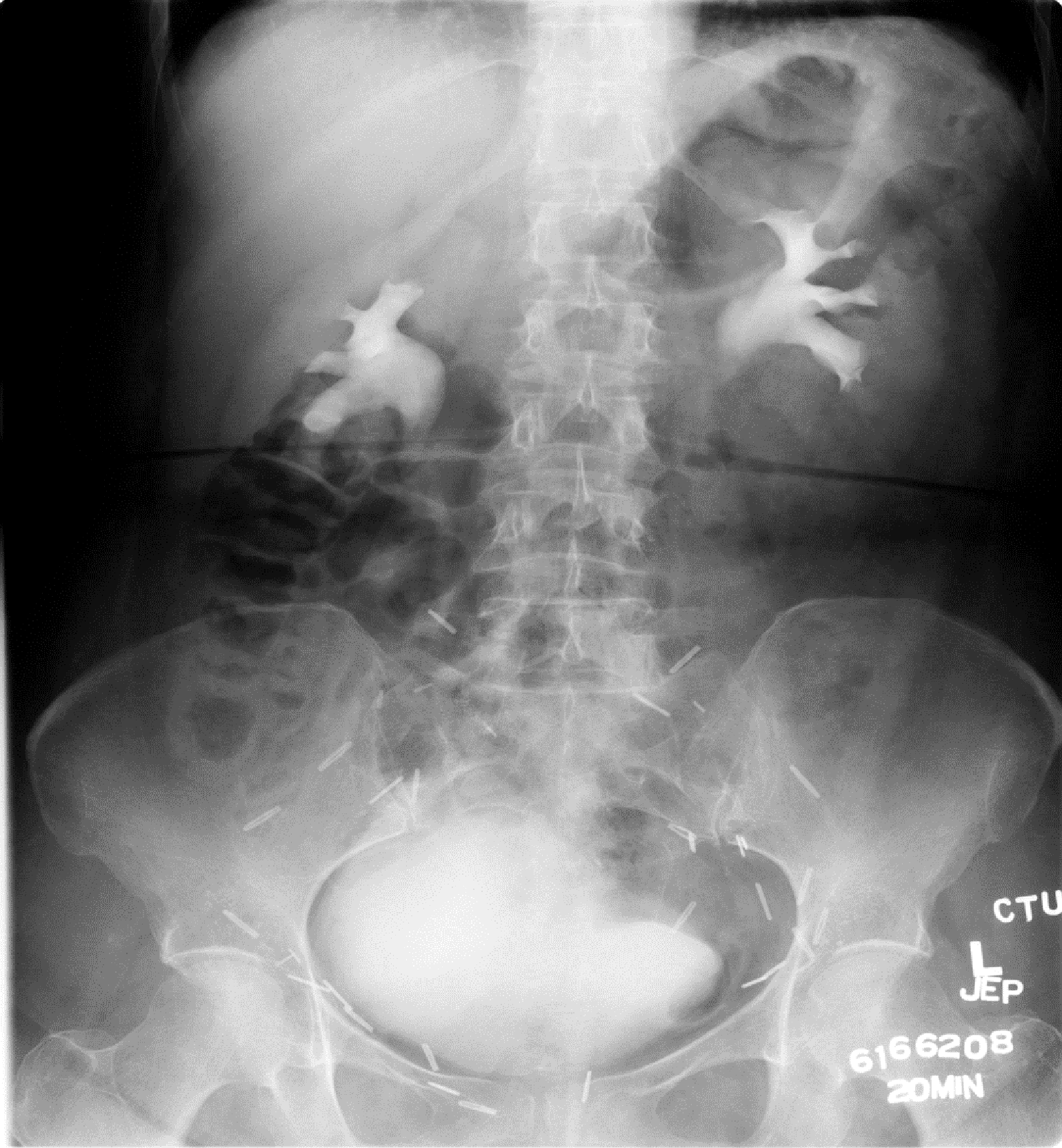 Orthotopic Neobladder Reconstruction Restores Quality of Life for ...