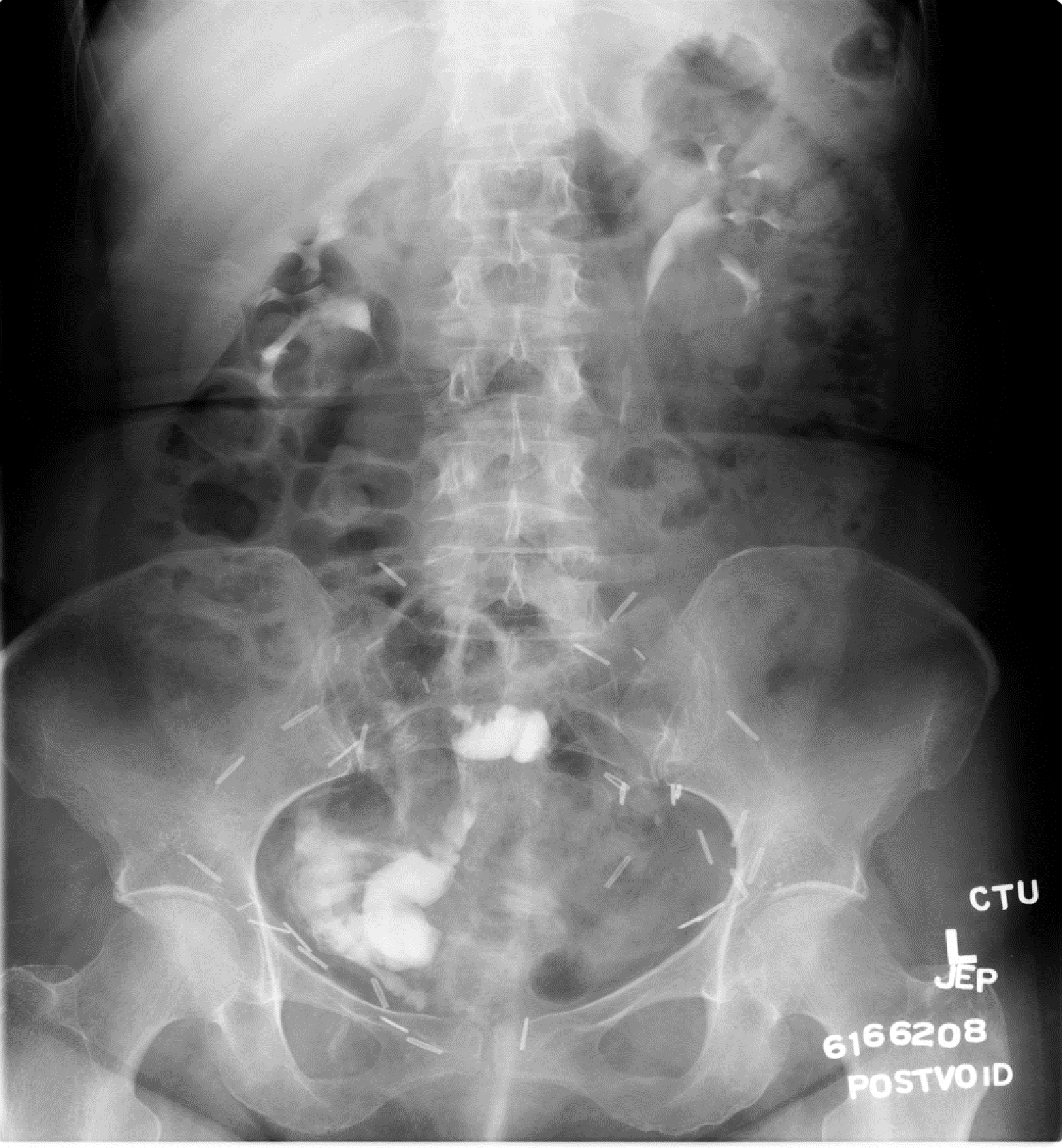 Orthotopic Neobladder Reconstruction Restores Quality of Life for ...