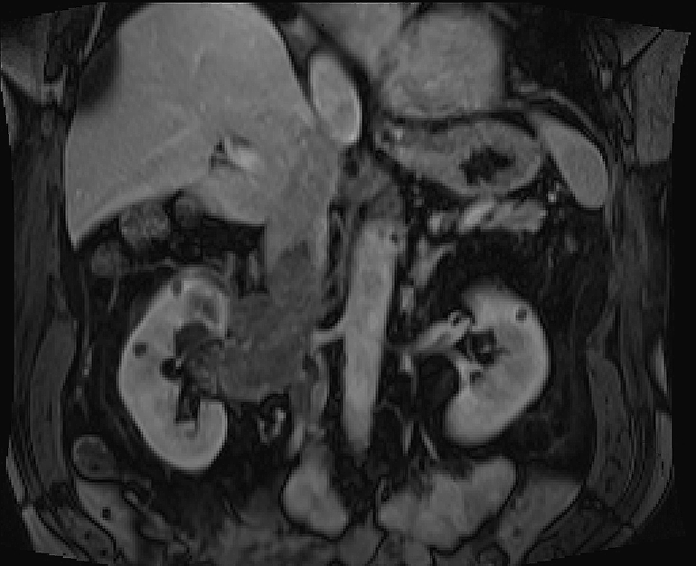 Improving the Safety of Vena Caval Thrombectomy in Kidney Cancer with ...